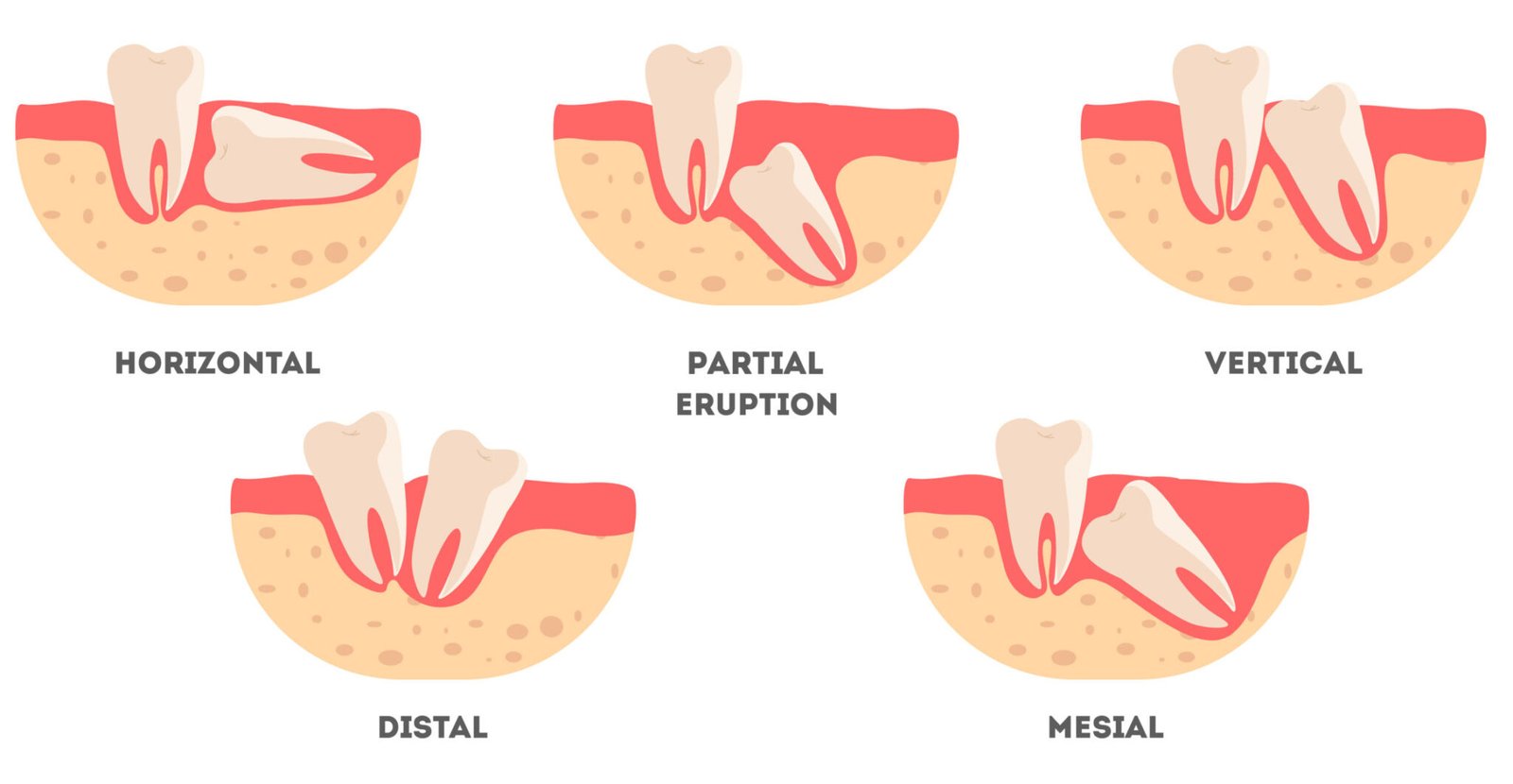 Wisdom Tooth Extractions - Brace Dental