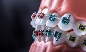 Braces - Brace Dental