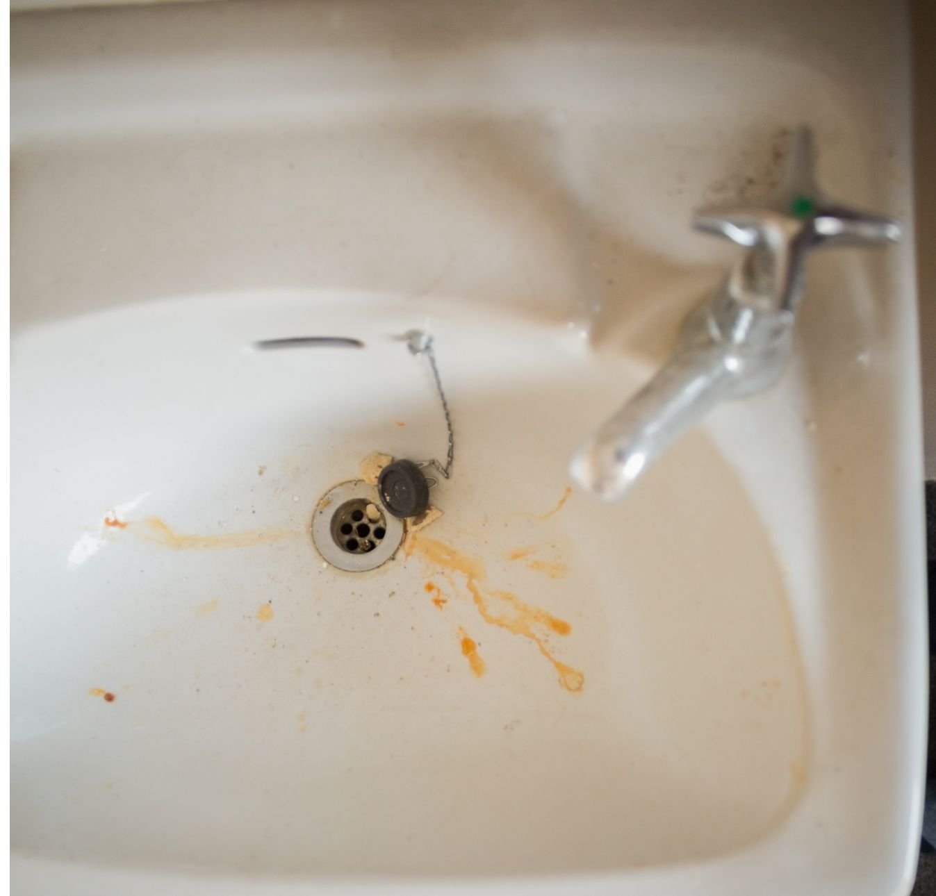 Bleeding Gums - Brace Dental